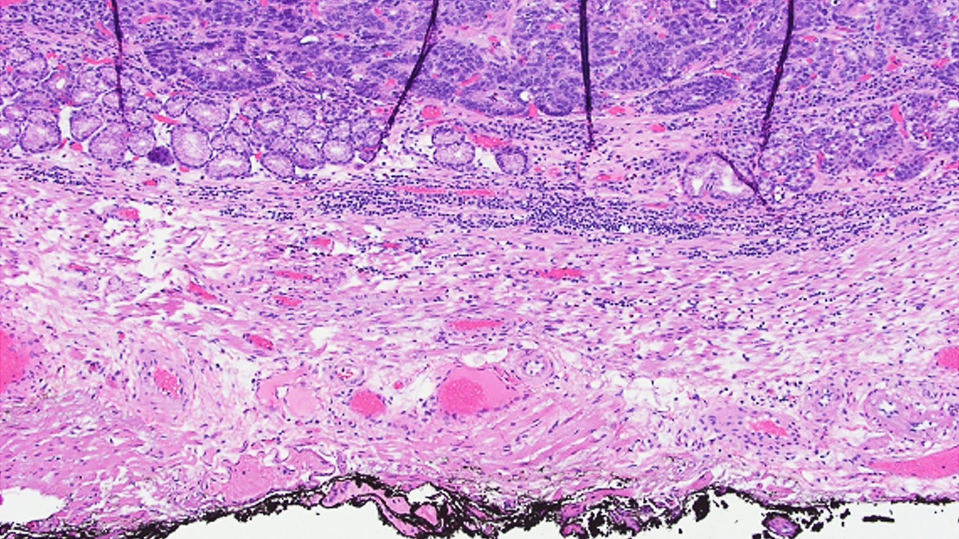 Deep Tumors Fully Resected With Endoscopic Submucosal Dissection Nyu