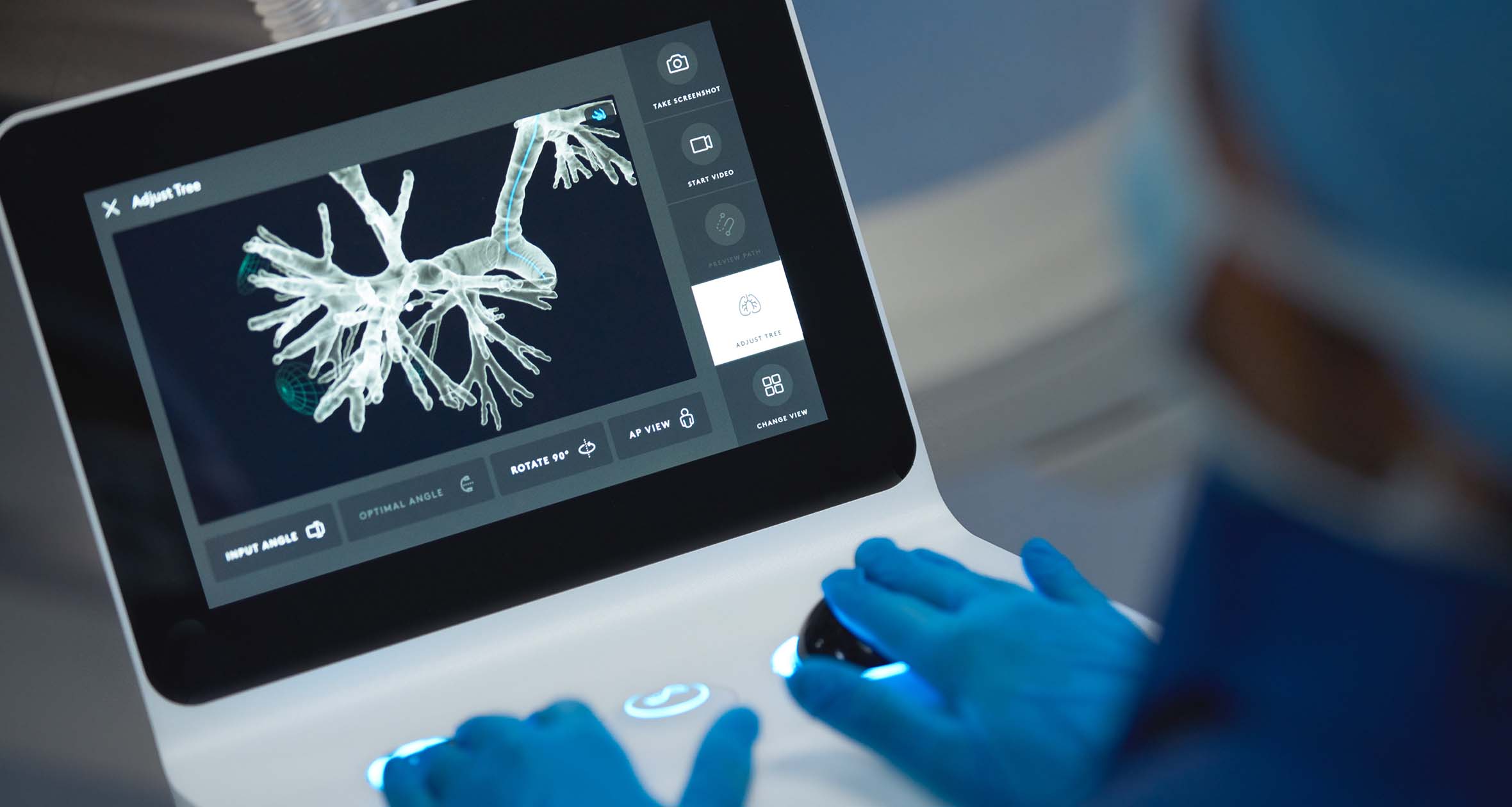 Improving Precision Diagnosis of Lung Nodules - NYU Langone Health ...
