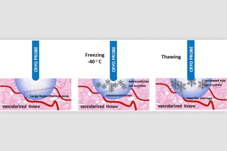 Salvage Cryoablation for Prostate Cancer | NYU Langone Health