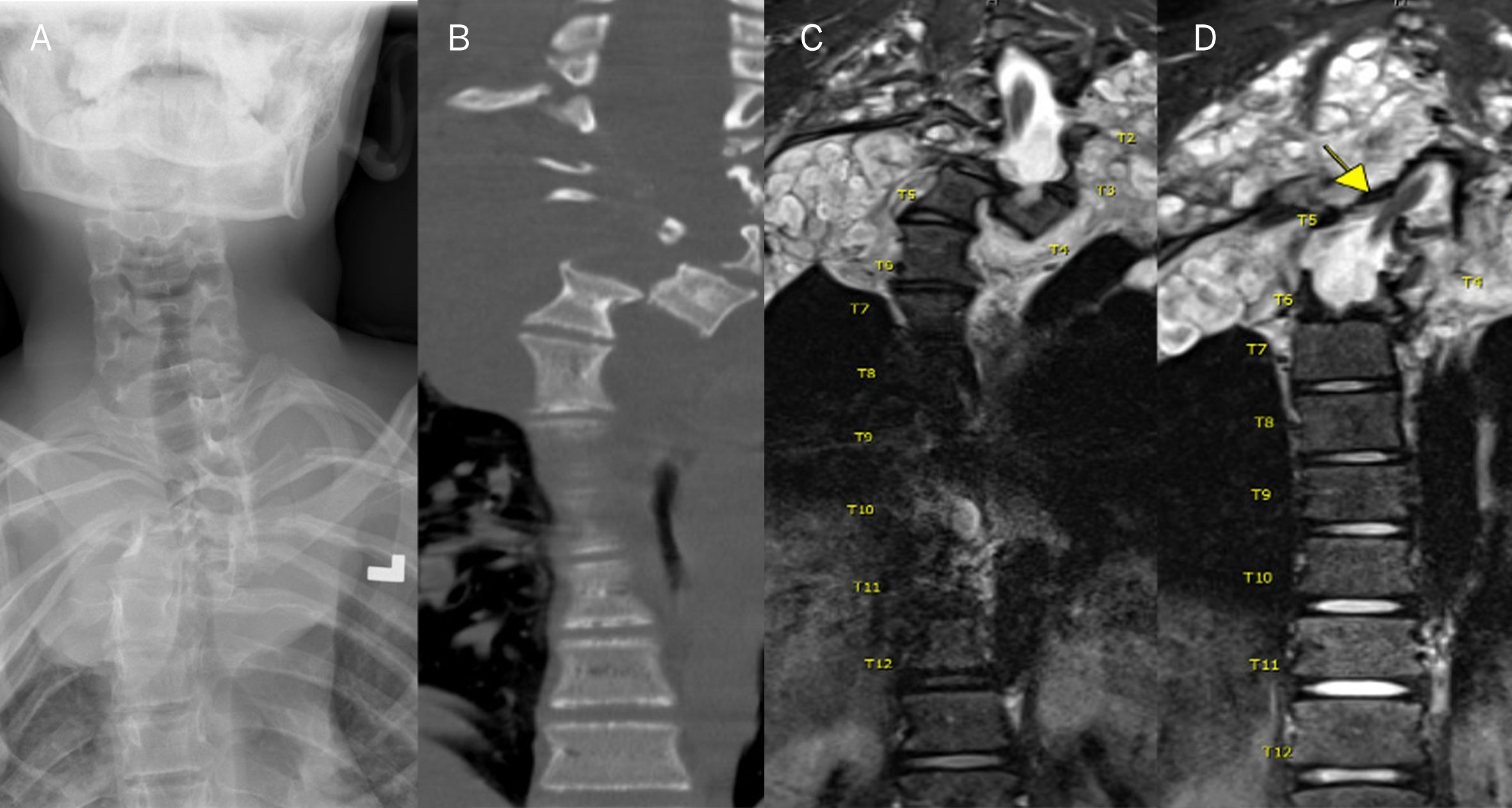 Surgery for NF1 Dystrophic Scoliosis | NYU Langone Health Physician Focus
