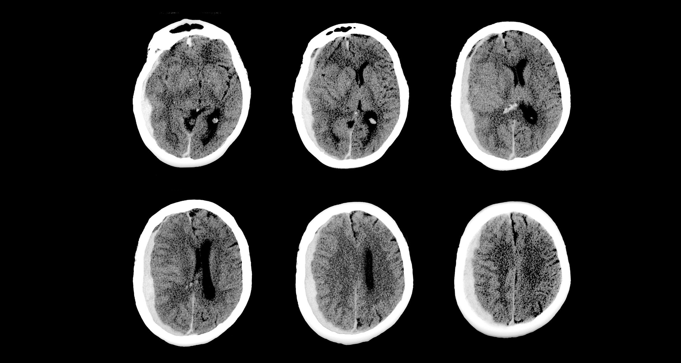 Testing a New Embolic Material for Chronic Subdural Hematoma - NYU ...