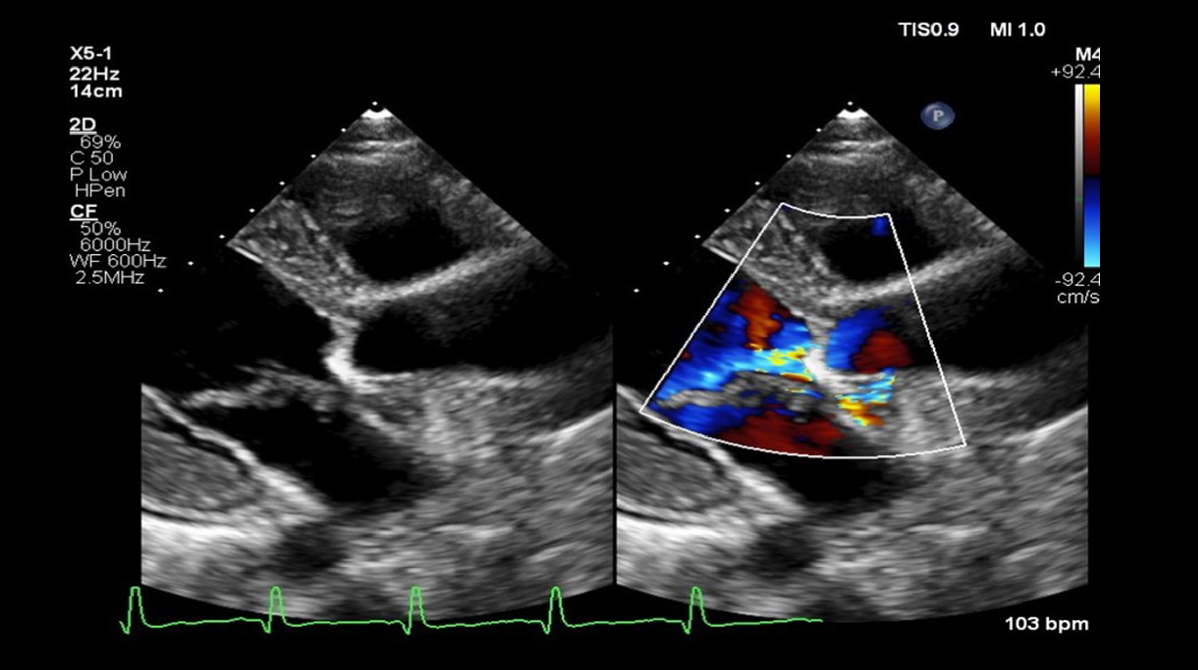 A Case of Untreated Multivalvular Endocarditis with Abscess | NYU ...