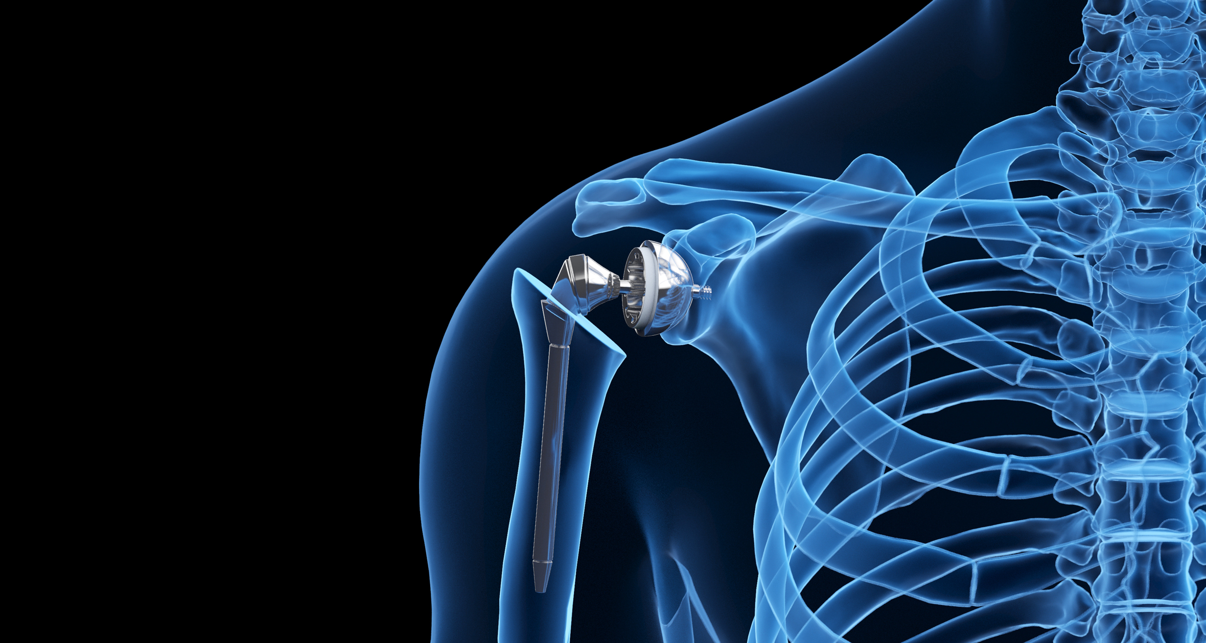 Computer-Assisted Navigation Is Safe & Effective for TSA | NYU Langone ...