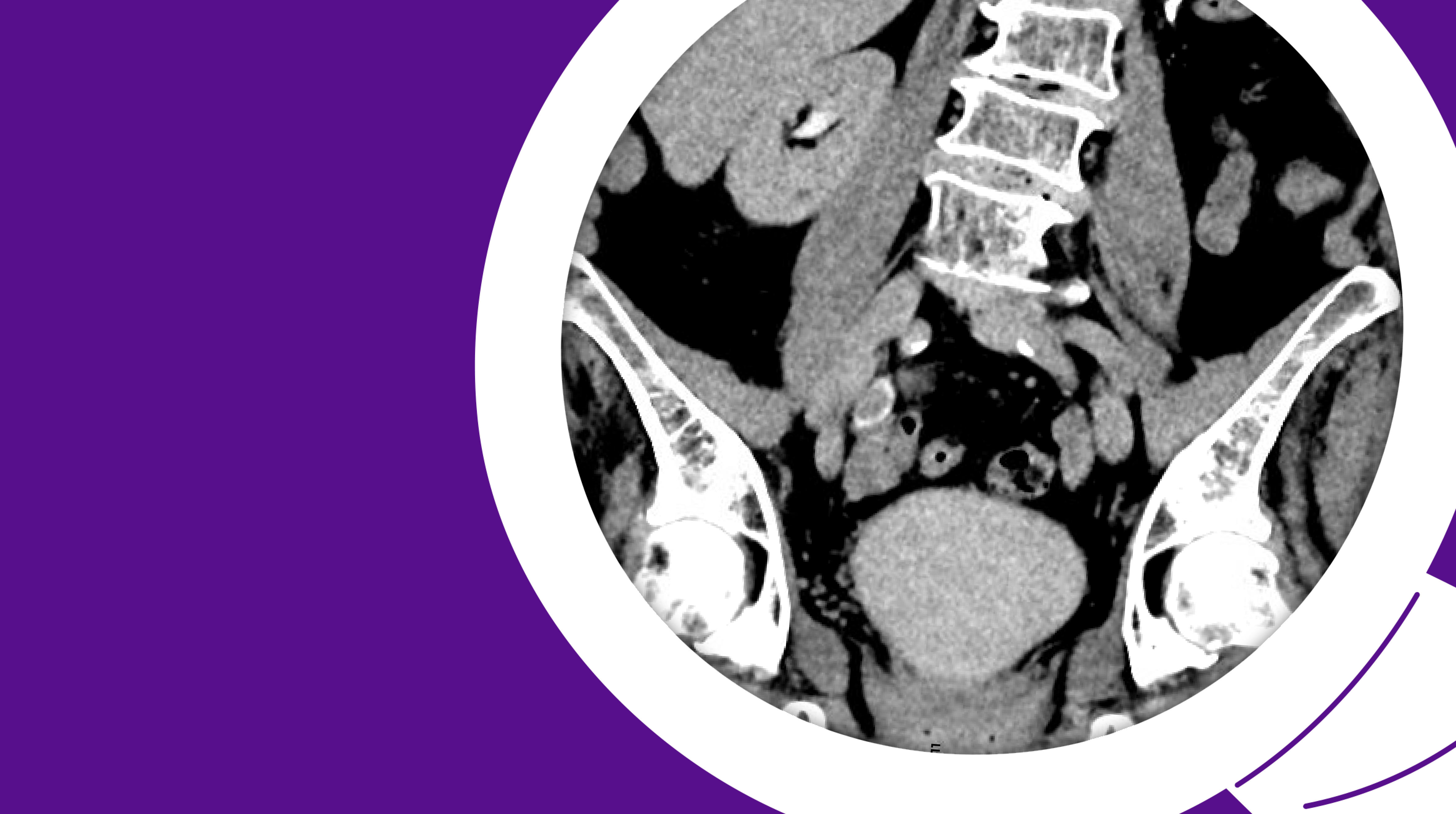 Jelmyto Helps Patient with Single Kidney Avoid Dialysis | NYU Langone ...