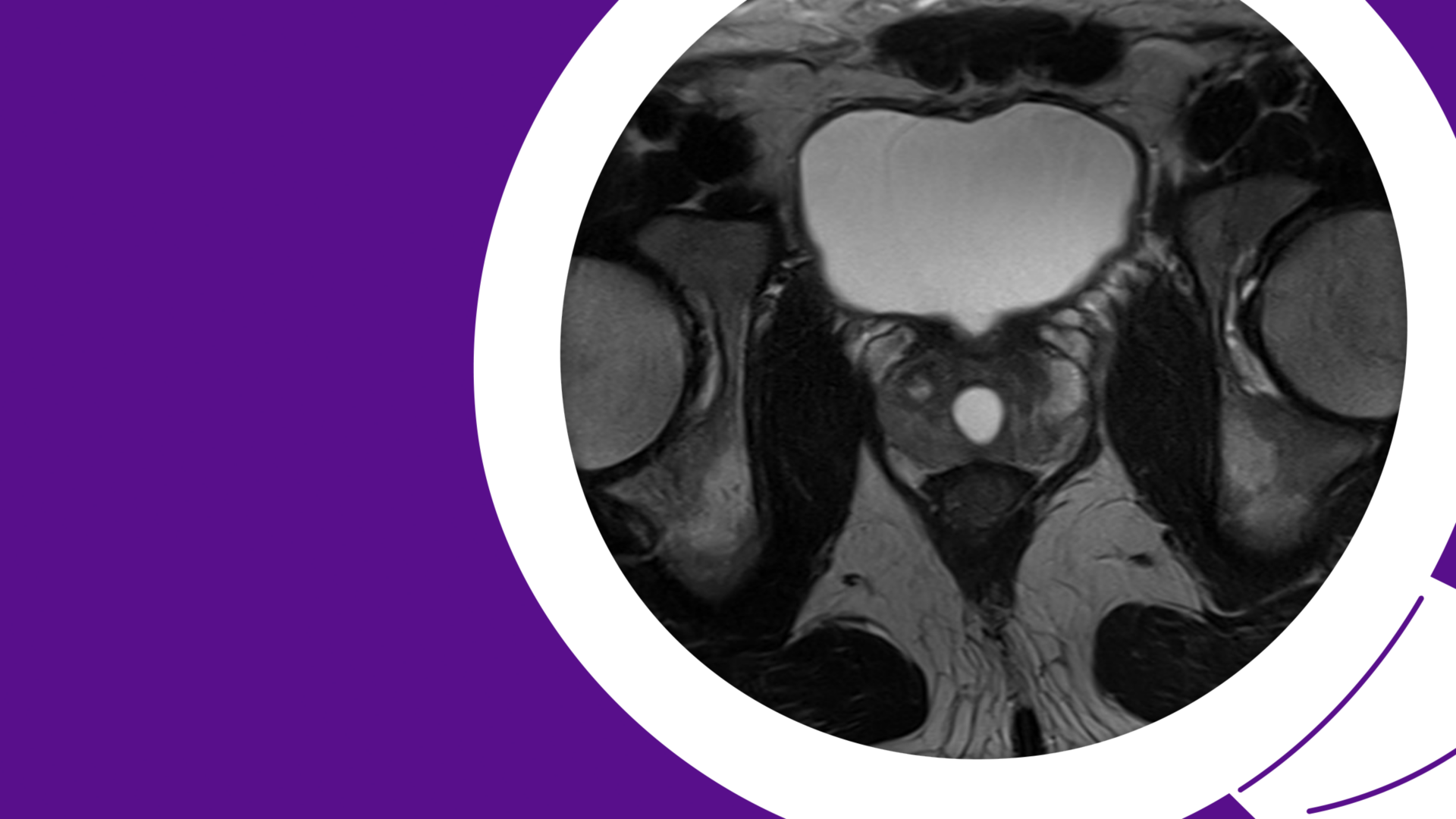Optilume Success After Urethroplasty | NYU Langone Health Physician Focus
