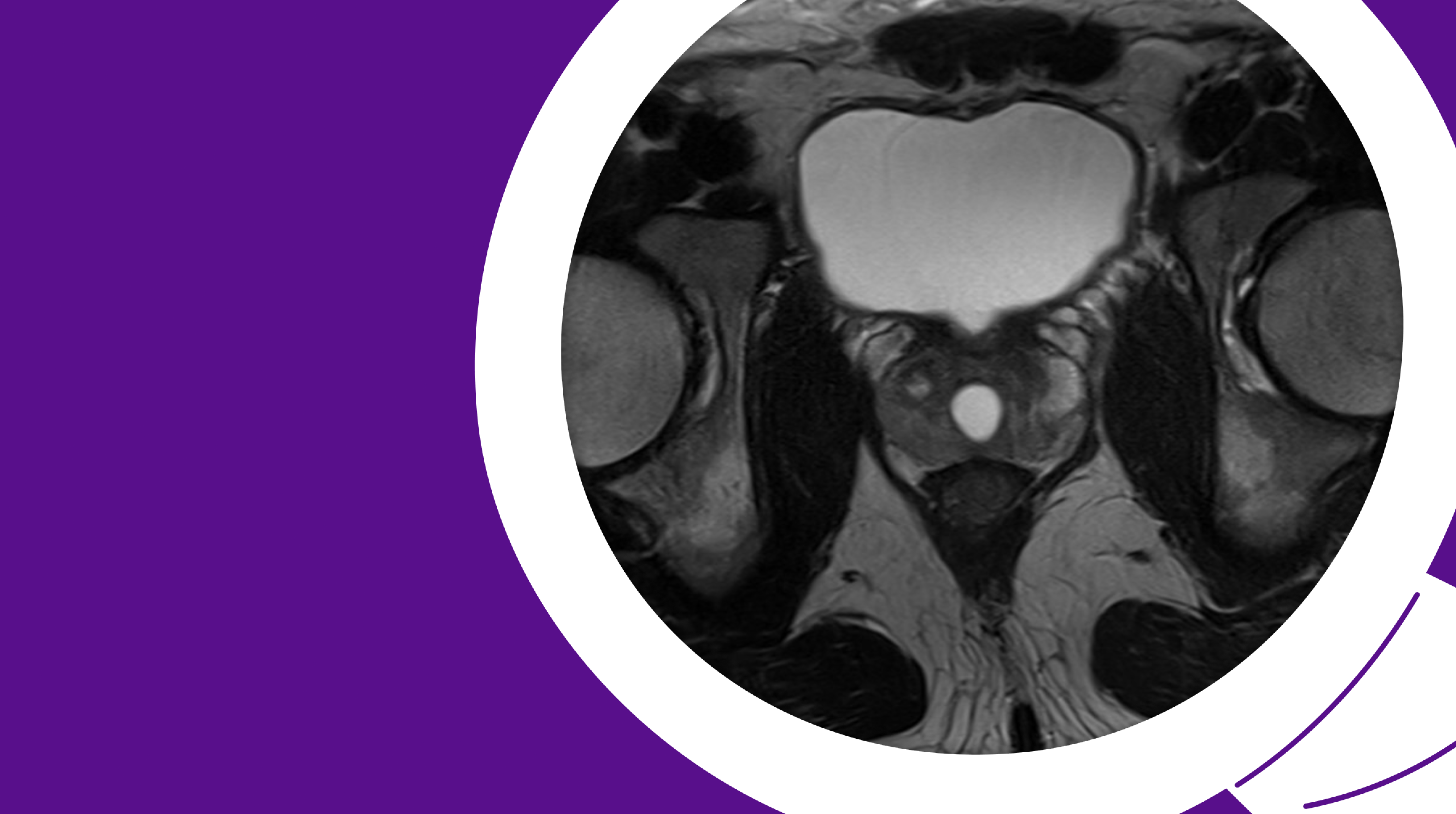 Midline Prostatic Cyst and Infertility: TURED Success Story | NYU ...