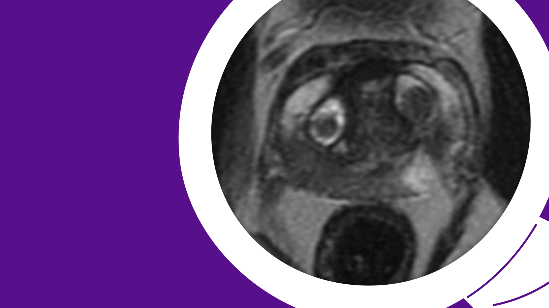 New Classification System for Urethral Stricture Disease