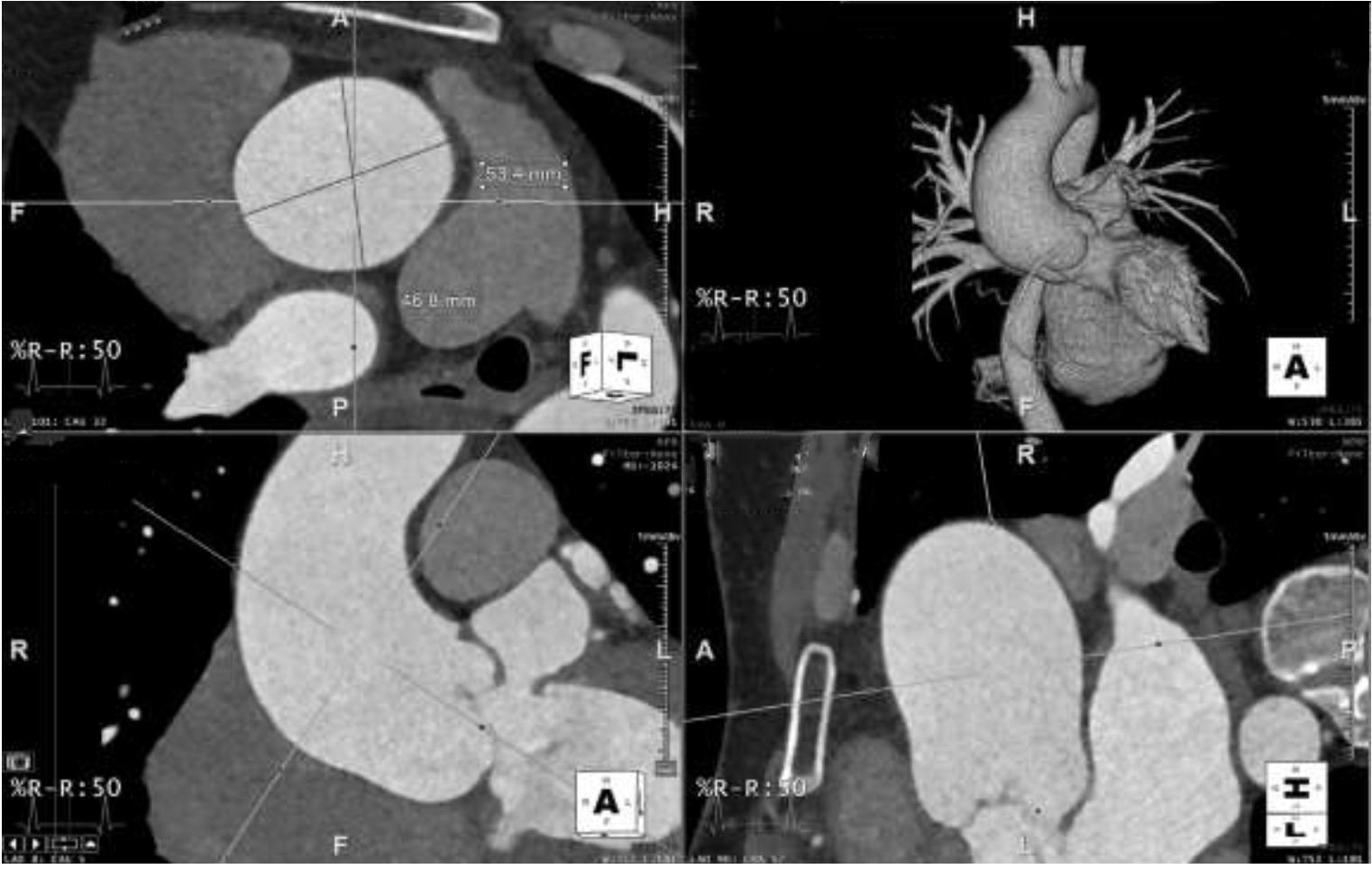 Two Large LVOT Pseudoaneurysms Prompt Expedited Surgery - NYU Langone ...