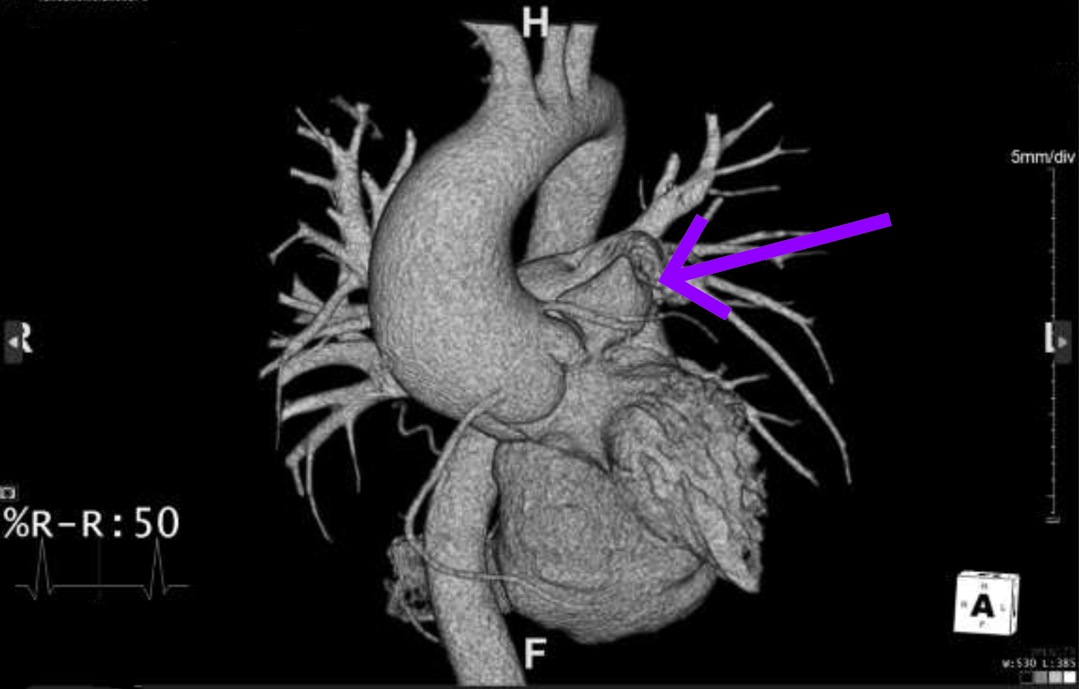 Two Large LVOT Pseudoaneurysms Prompt Expedited Surgery - NYU Langone ...