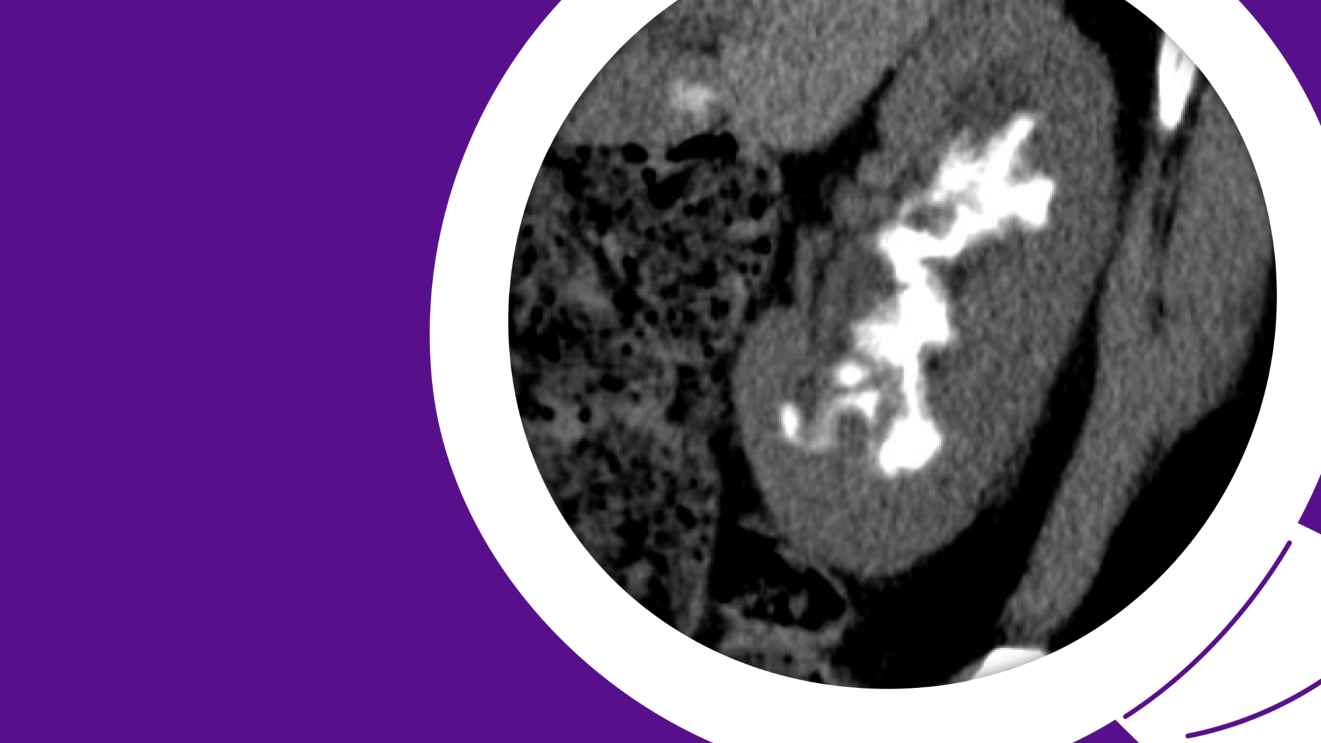 Optilume Success After Urethroplasty | NYU Langone Health Physician Focus