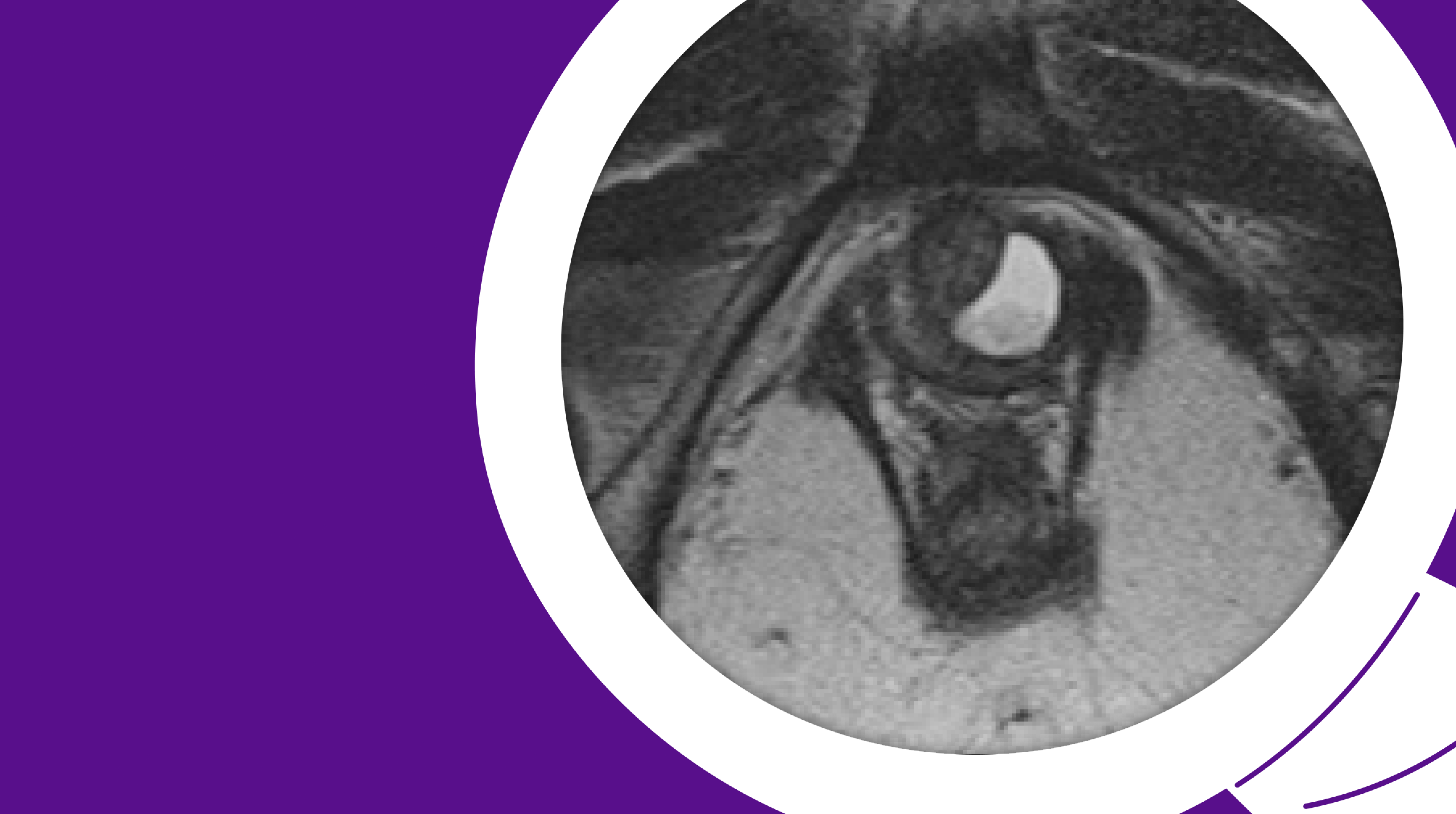 Female Urethral Diverticulum: Management Options in the Asymptomatic ...