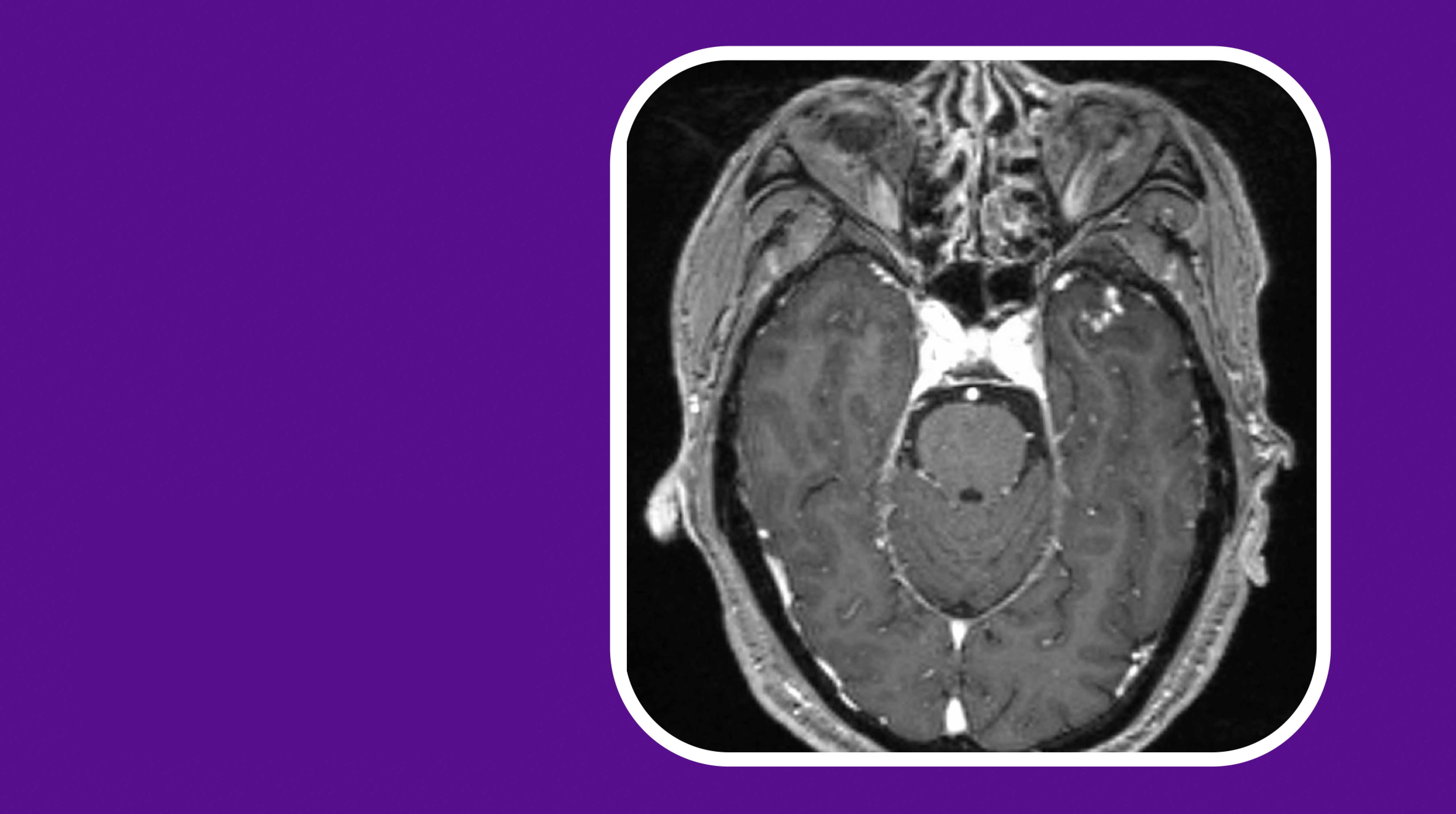 Surgeons Perform Novel Transorbital AVM Surgery - NYU Langone Health ...