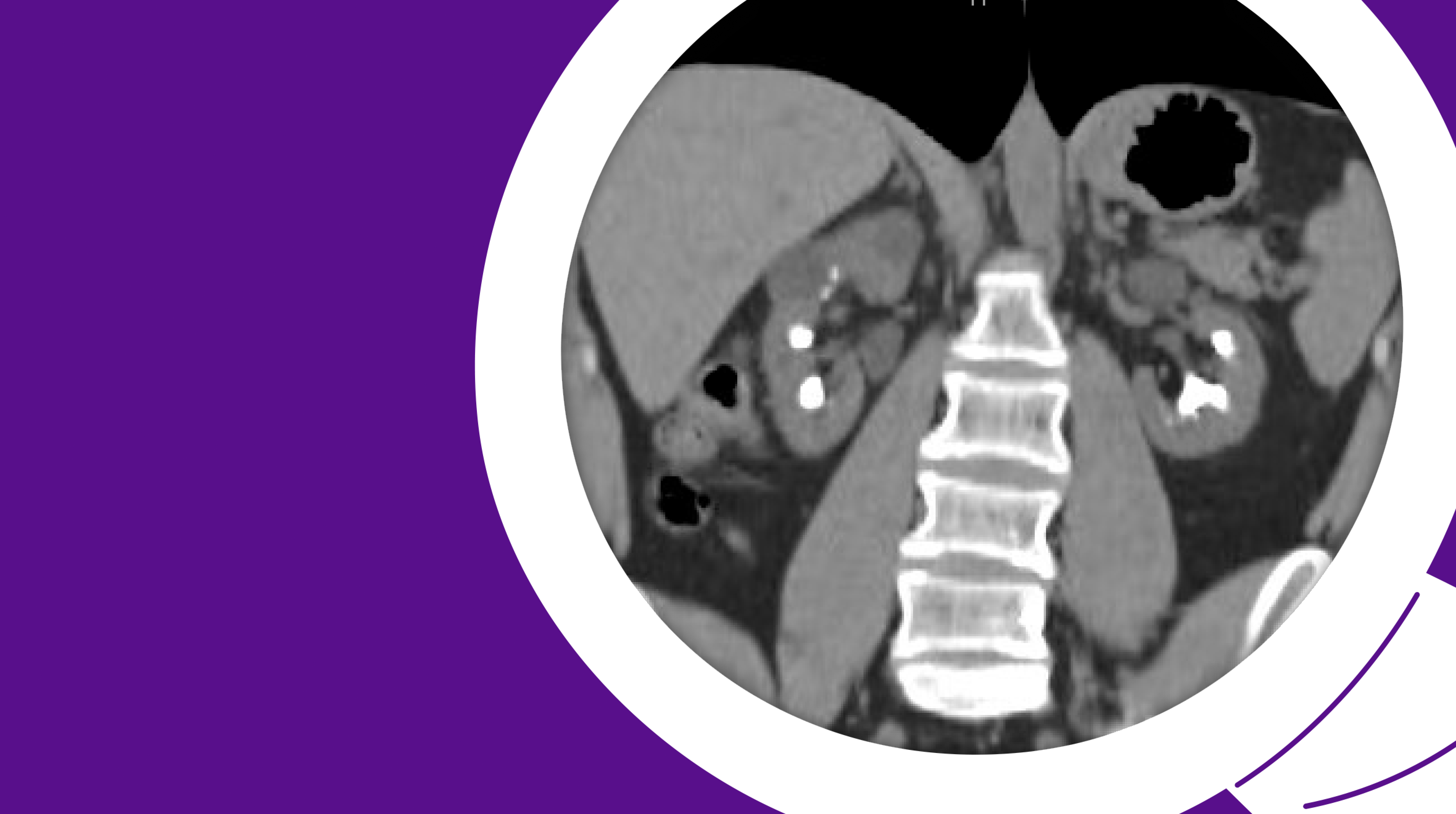 Stone Clearance in Dent Disease | NYU Langone Health Physician Focus