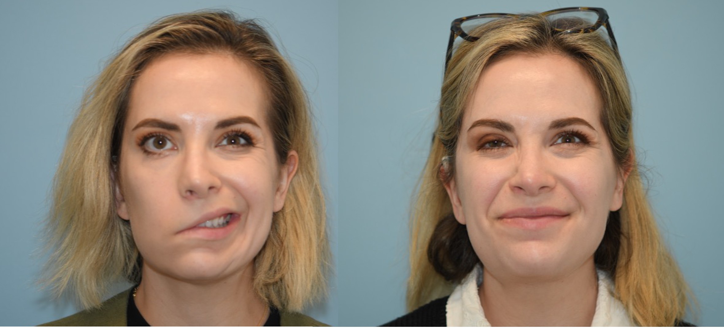 Advanced Dual Nerve Transfer Restores Facial Reanimation in Patient ...