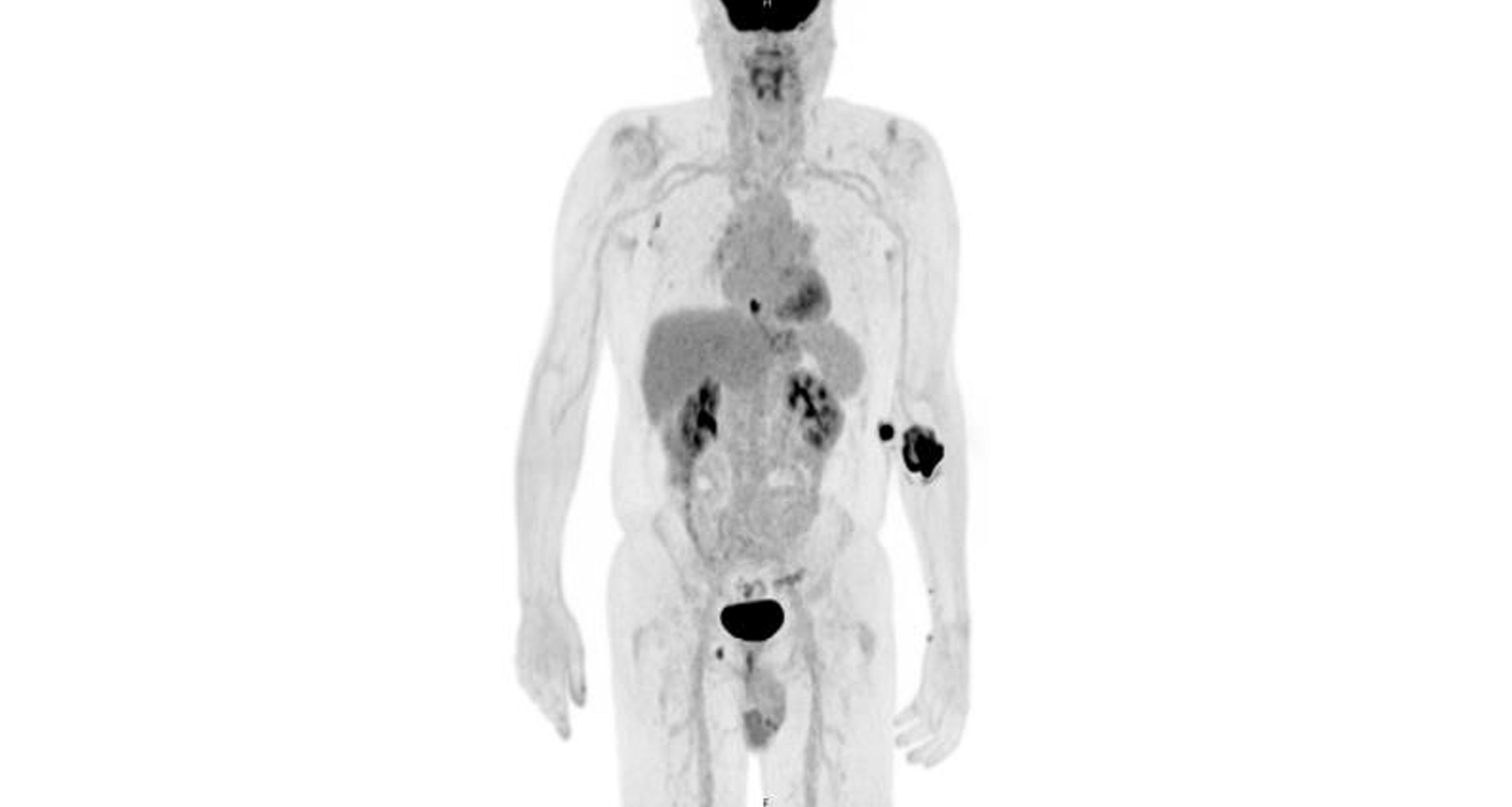 Robotic Ivor Lewis Esophagectomy Cuts Hospital Stay to Four Days - NYU ...