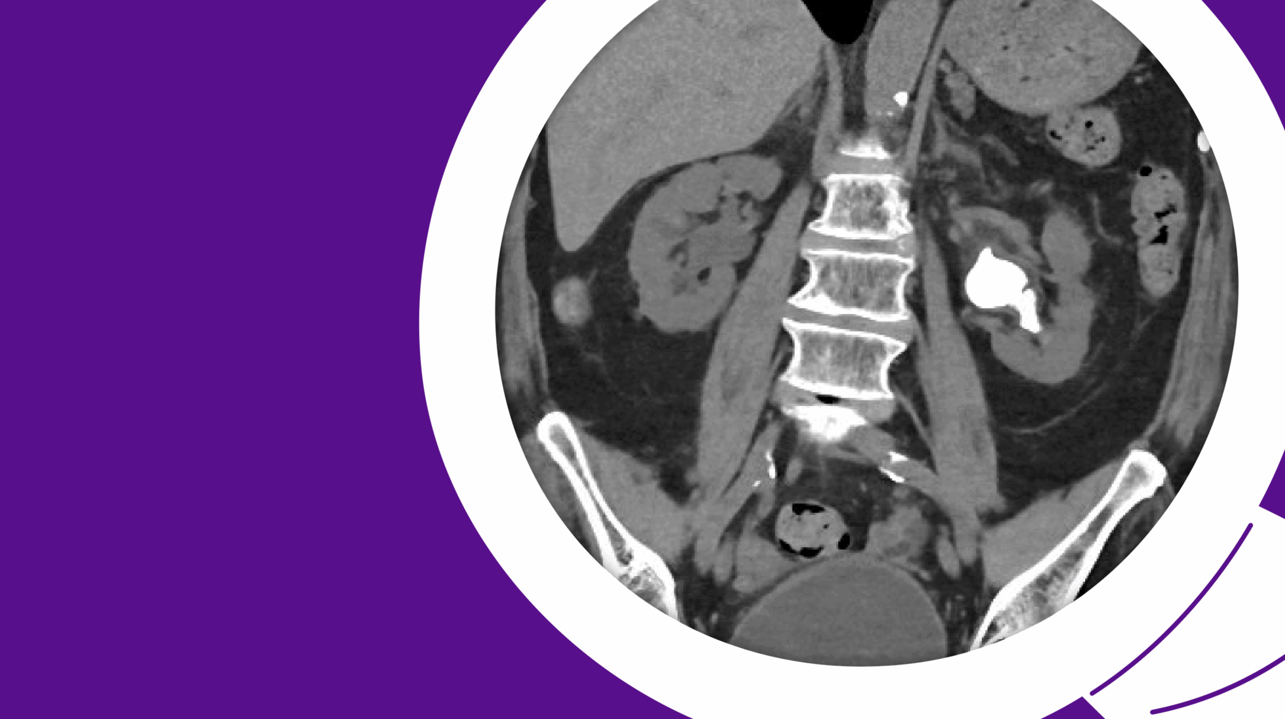 Staghorn Stone Treatment in a High-Risk Elderly Patient | NYU Langone ...