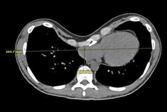 Nuss Procedure for Complex Pectus Excavatum| NYU Langone Health ...