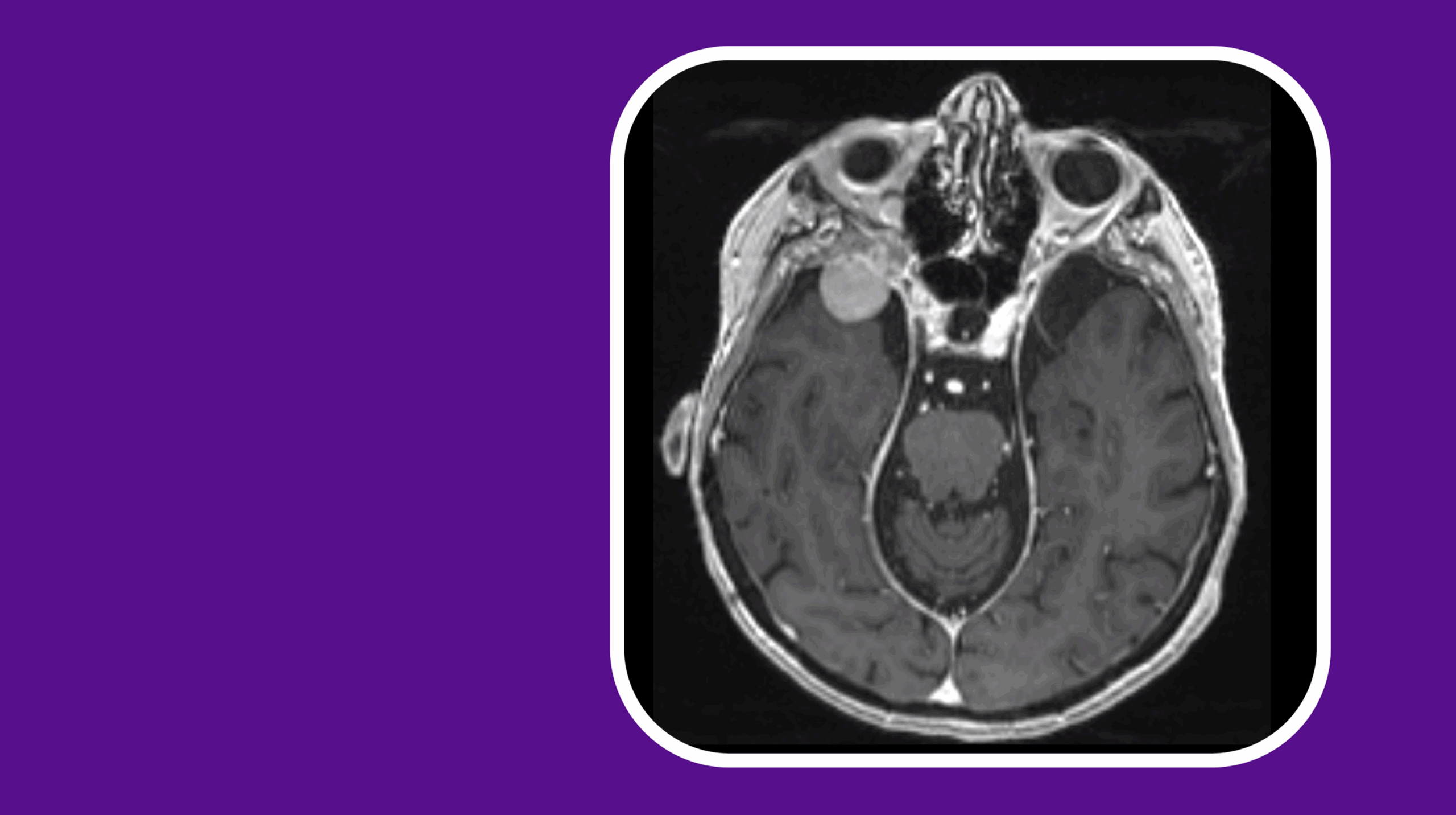 TONES for a Spheno-Orbital Meningioma | NYU Langone Health Physician Focus