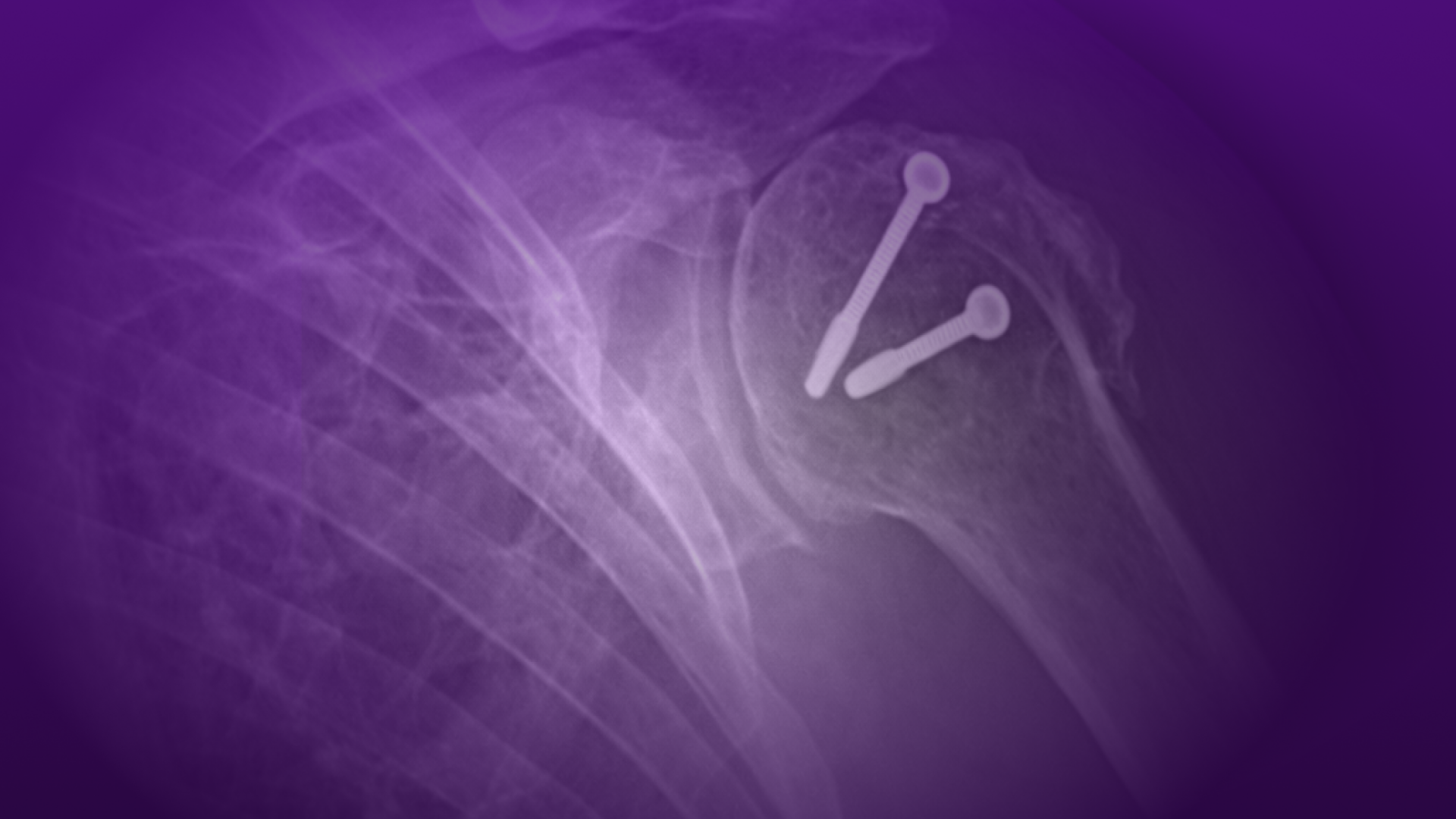 Hybrid Fixation in Total Hip Arthroplasty | NYU Langone Health ...