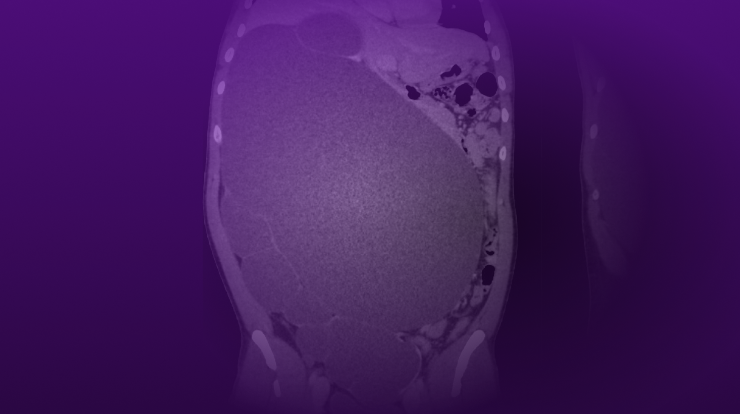 Robotic Management of Giant Hydronephrosis & Contralateral UPJ ...