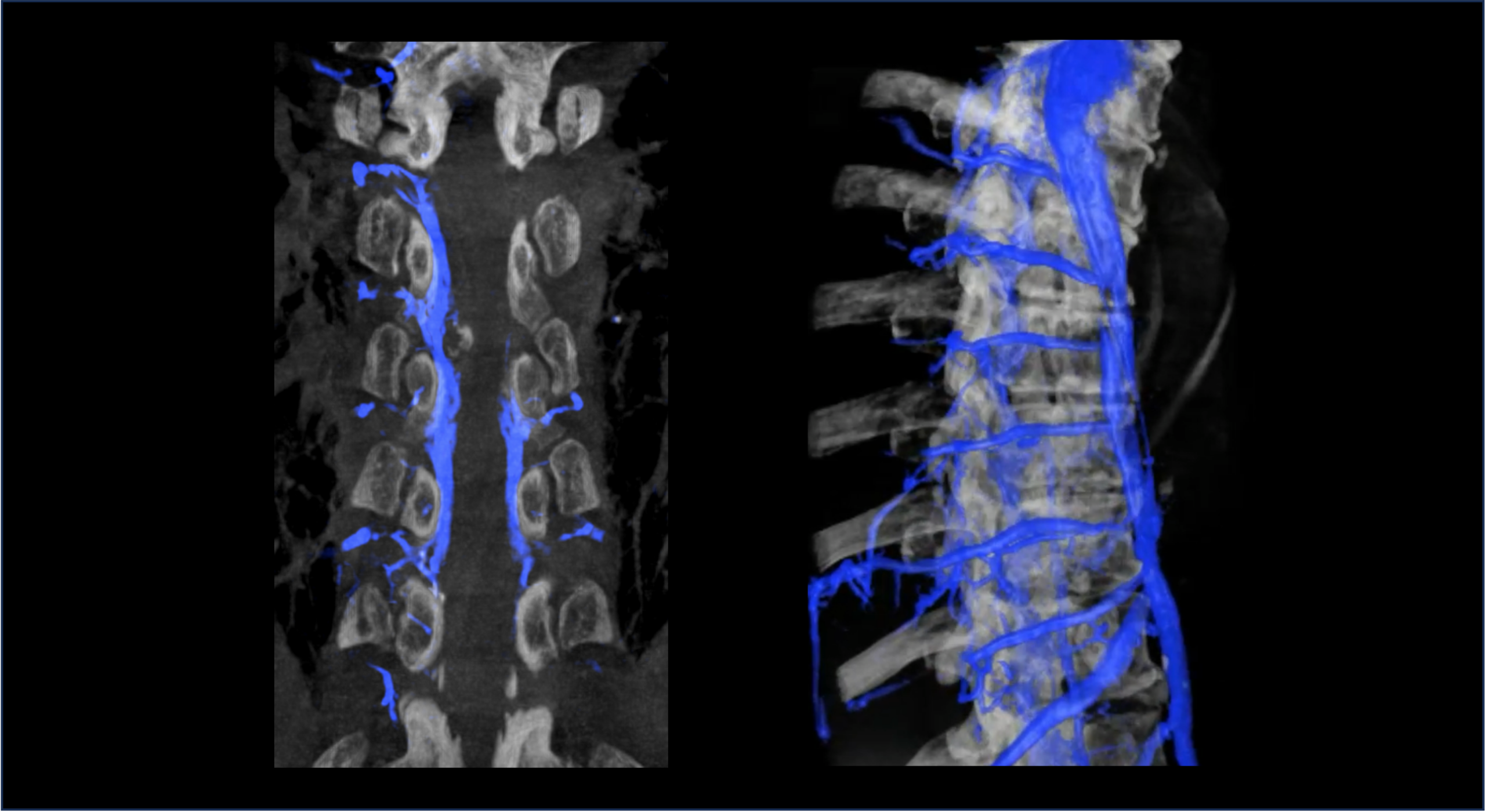 CSF–Venous Fistulas: Enhancing Outcomes Through Spinal Vein Mastery ...