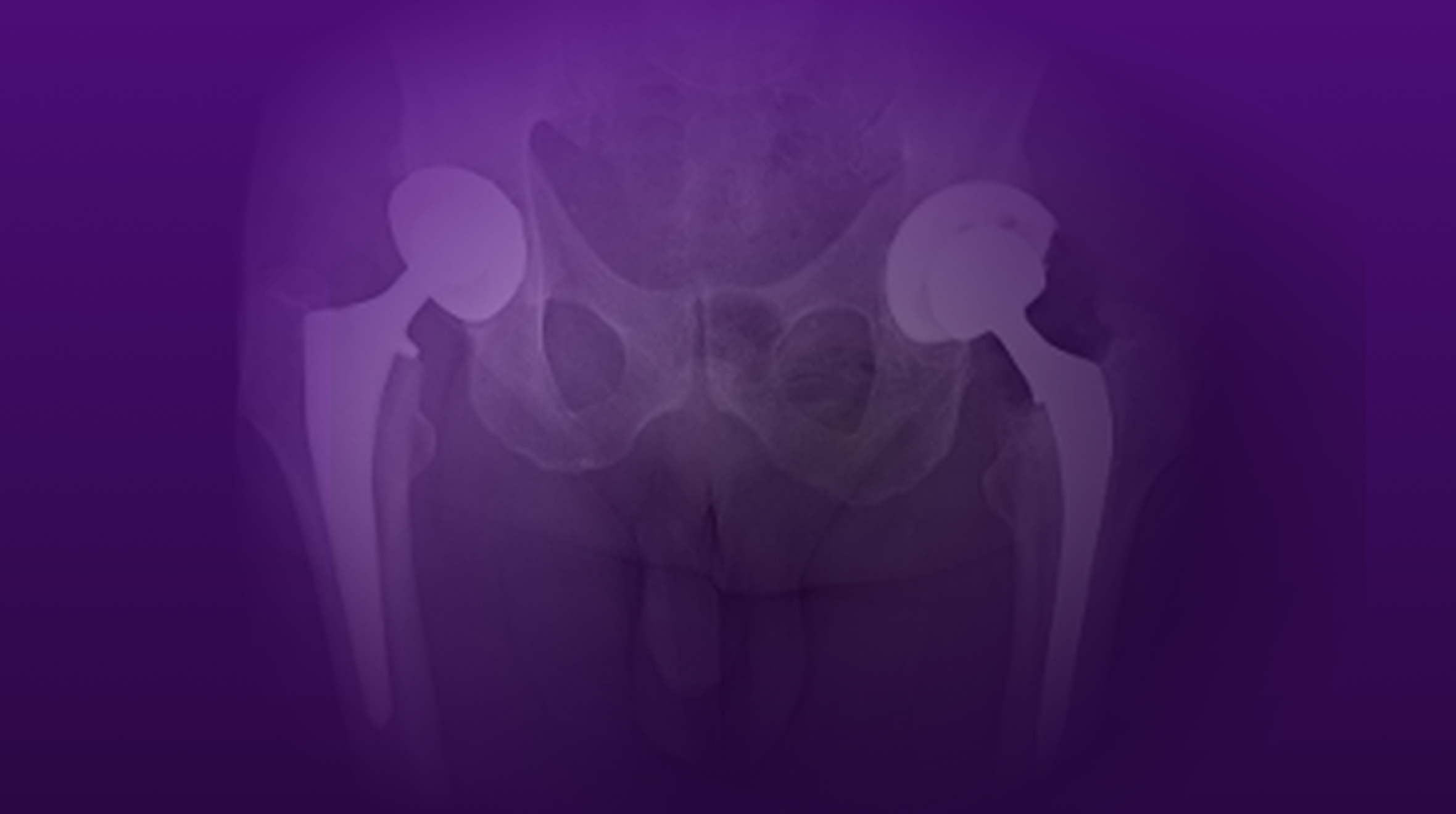 Hybrid Fixation in Total Hip Arthroplasty | NYU Langone Health ...